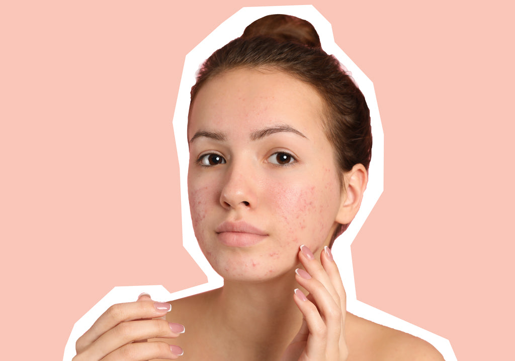 Acne Scarring Treatment | Go-To Guide | Go-To Skin Care